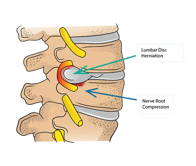 Lumbar Spondylosis & Disc Compression